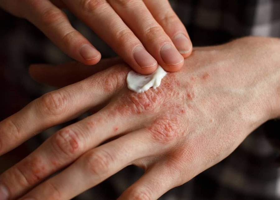 Eczeem, een onschuldige huidaandoening? - Pazzox, online apotheek